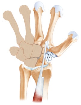 Rhizarthrose